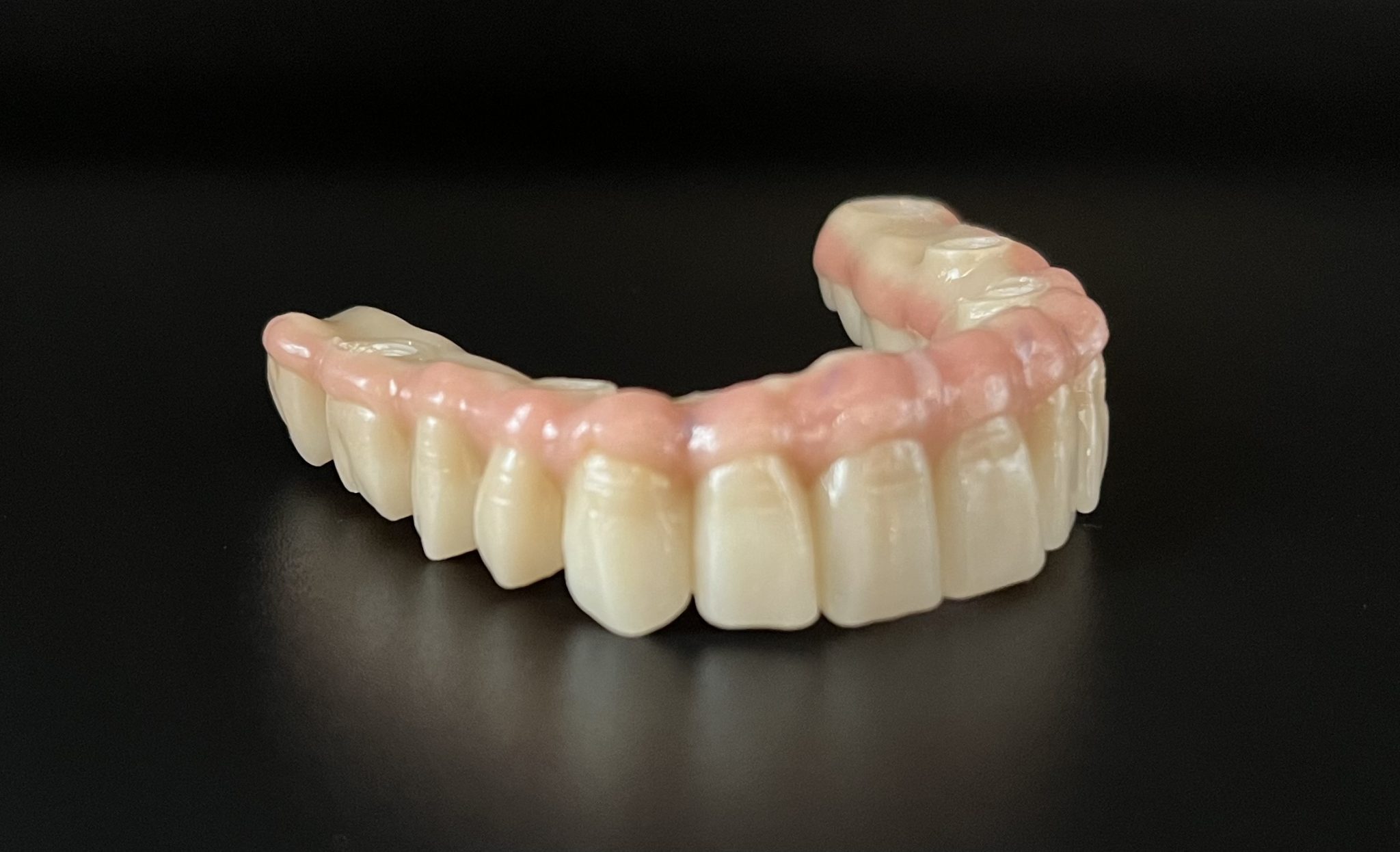 Bridge transvissé zircone stratifiée - Gagnaire